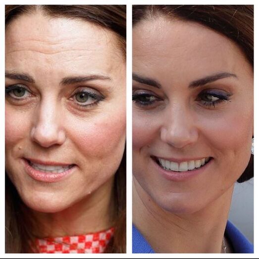 Novo vício da duquesa? Kate Middleton "ama um pouco de botox", garante ...